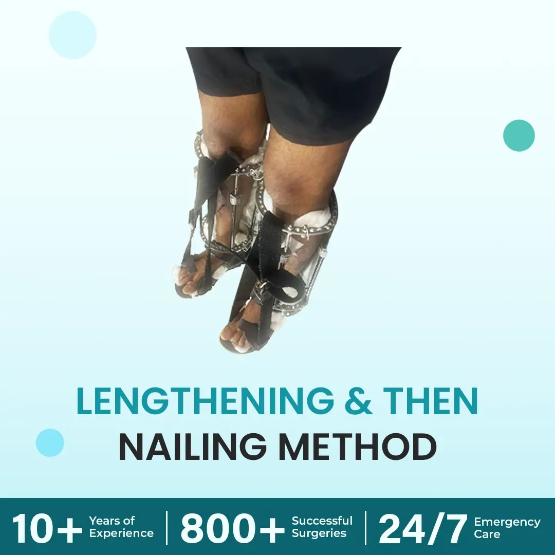 Lengthening And Then Nailing (LATN) Method - Heights Plus