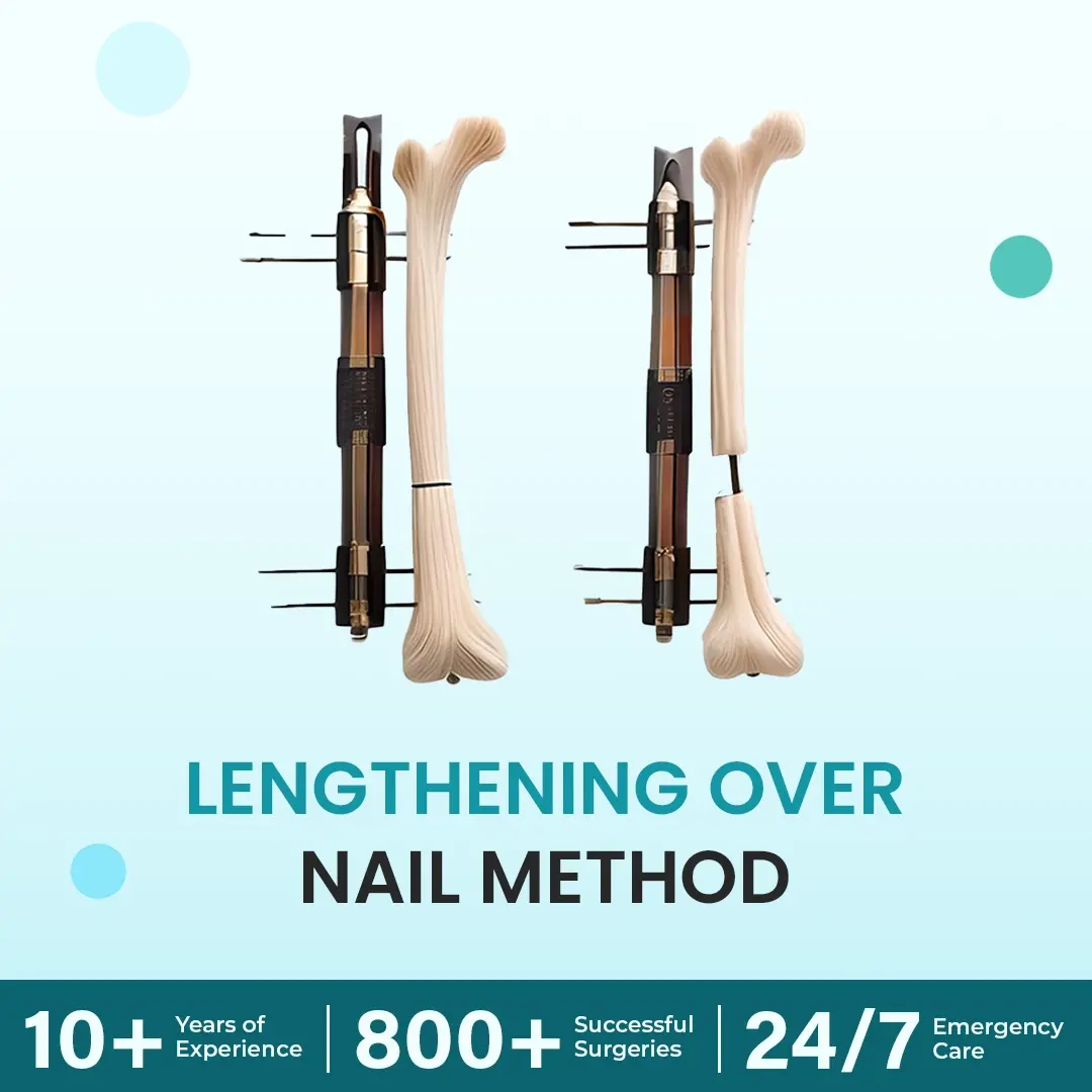 Lengthening Over Nail (LON) For Height Increase - Heights Plus