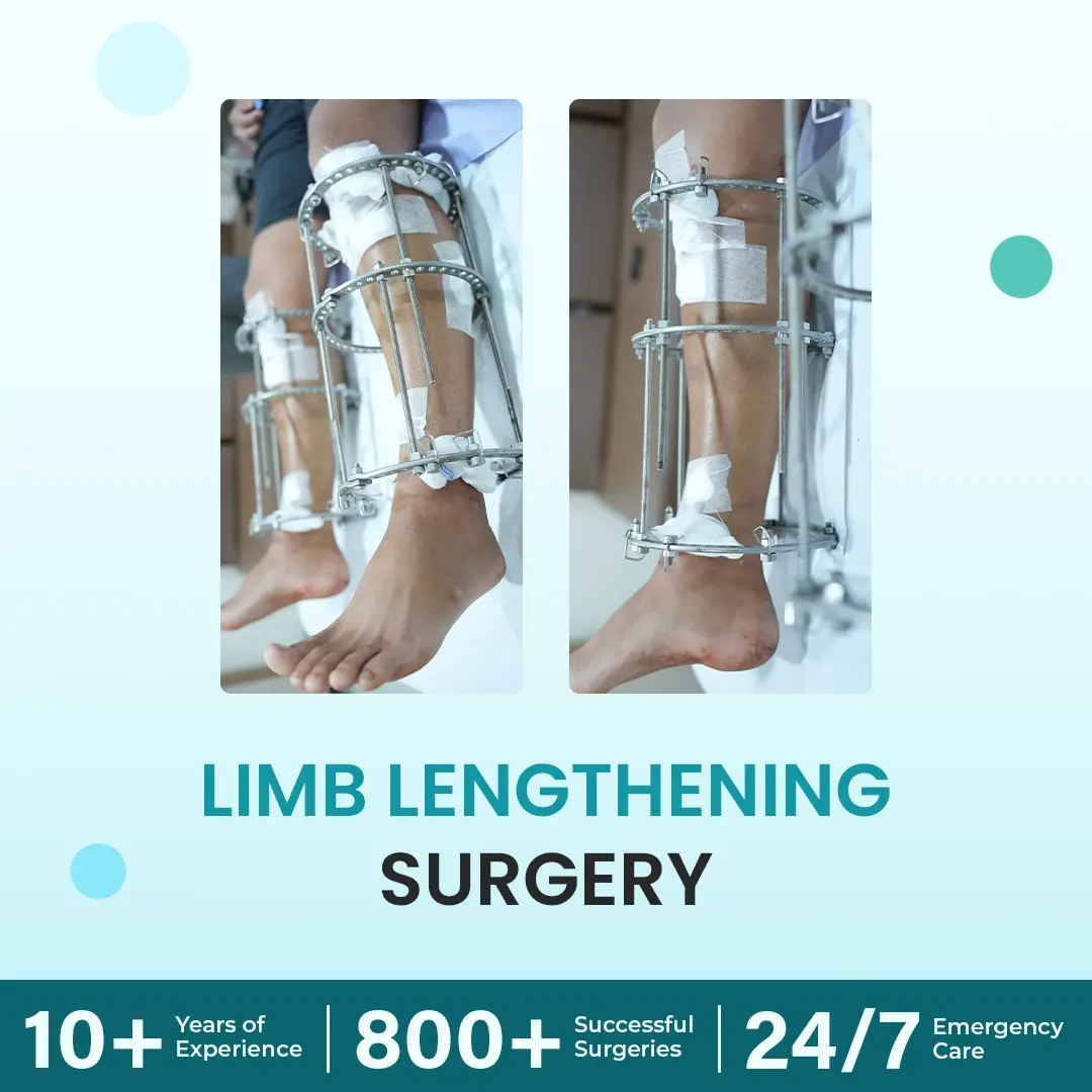Limb lengthening Surgery Treatment - Heights Plus