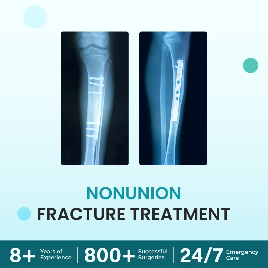 Nonunion Fracture Treatment - Heights Plus