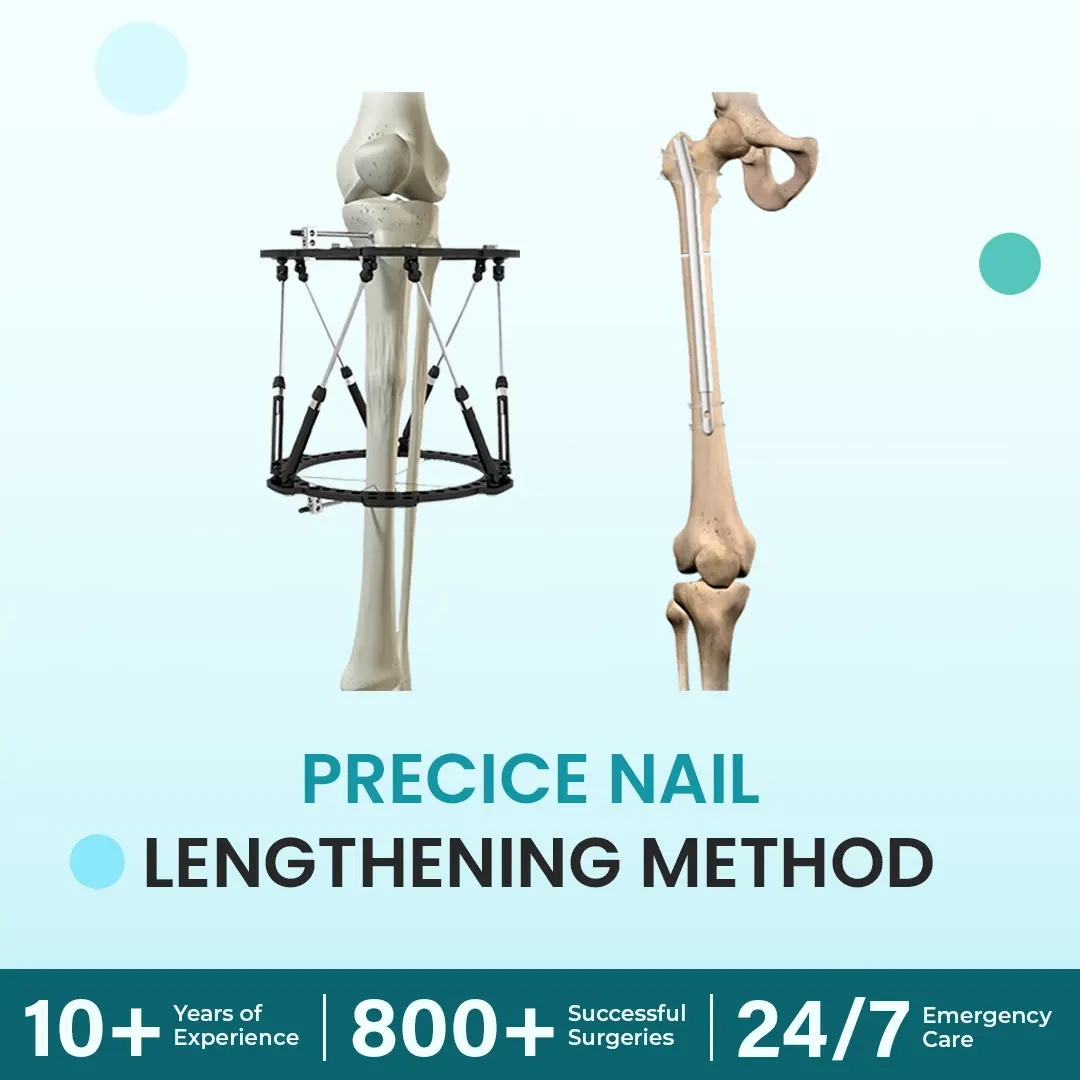 Precice Nail Lengthening Method - Heights Plus