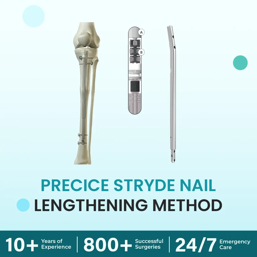 Precice Stryde Nail Lengthening Method - Heights Plus